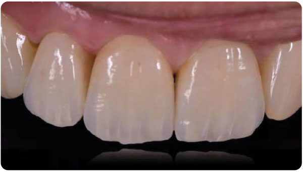 PRESSABLES – Garland Dental Services
